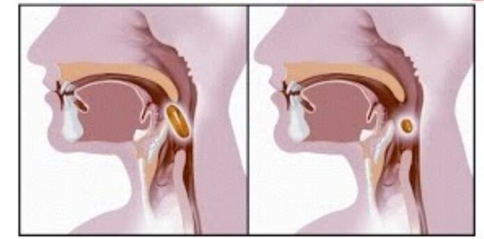 How to Swallow Properly for Mewing